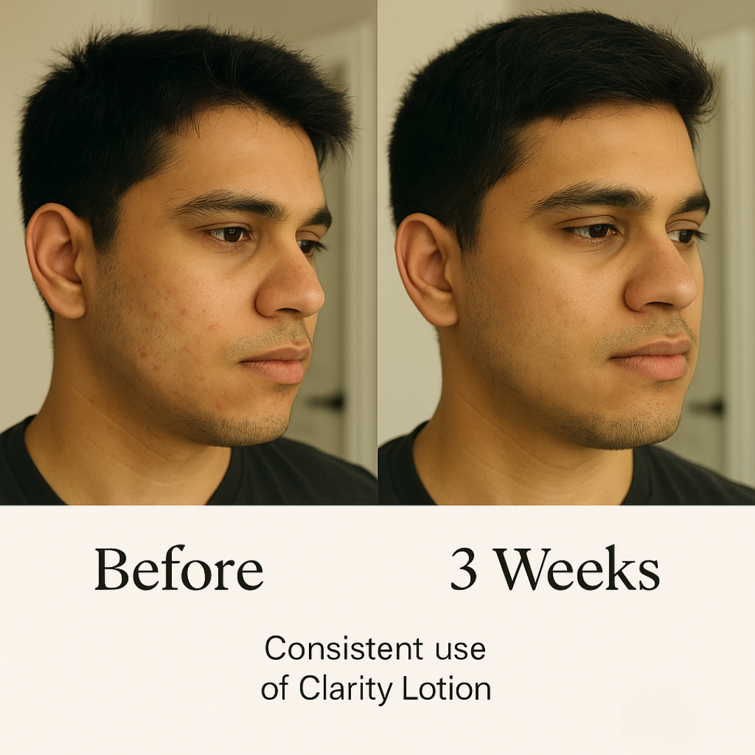 Clarity Lotion – Lightweight Acne Cream for Oily Skin India